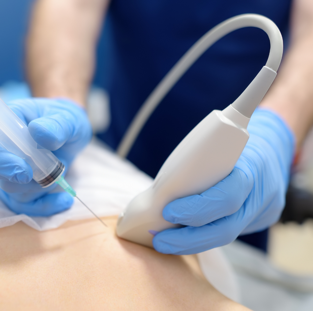 PUNÇÃO ASPIRATIVA POR AGULHA FINA – PAAF DE NÓDULO CERVICAL, EM ...